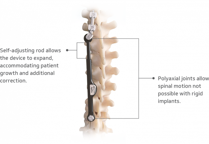 ApiFix Procedure | Adolescent Idiopathic Scoliosis Treatment