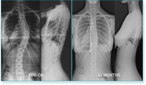 ApiFix Procedure | Adolescent Idiopathic Scoliosis Treatment