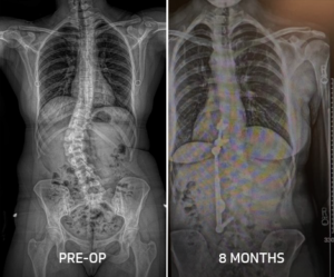 ApiFix | Adolescent Idiopathic Scoliosis | New Scoliosis Treatment