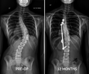 New Scoliosis Treatment Without Fusion | ApiFix